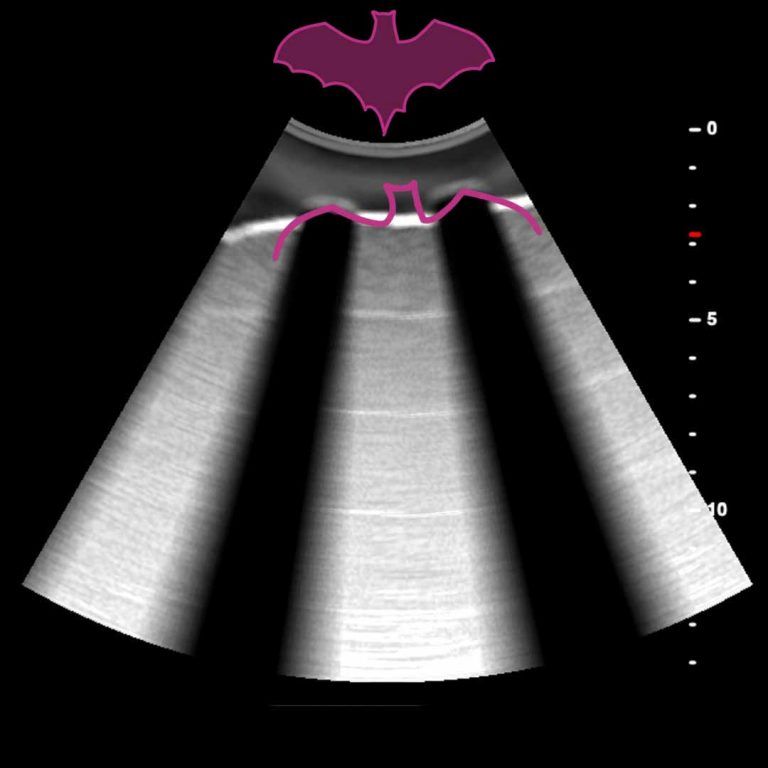 Lung ultrasound using the POCUS protocol
