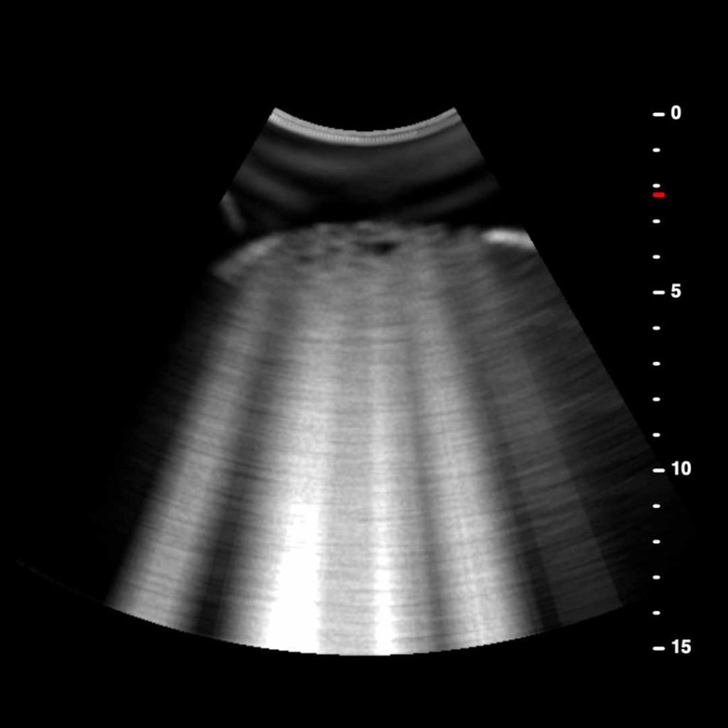 Lung ultrasound using the POCUS protocol