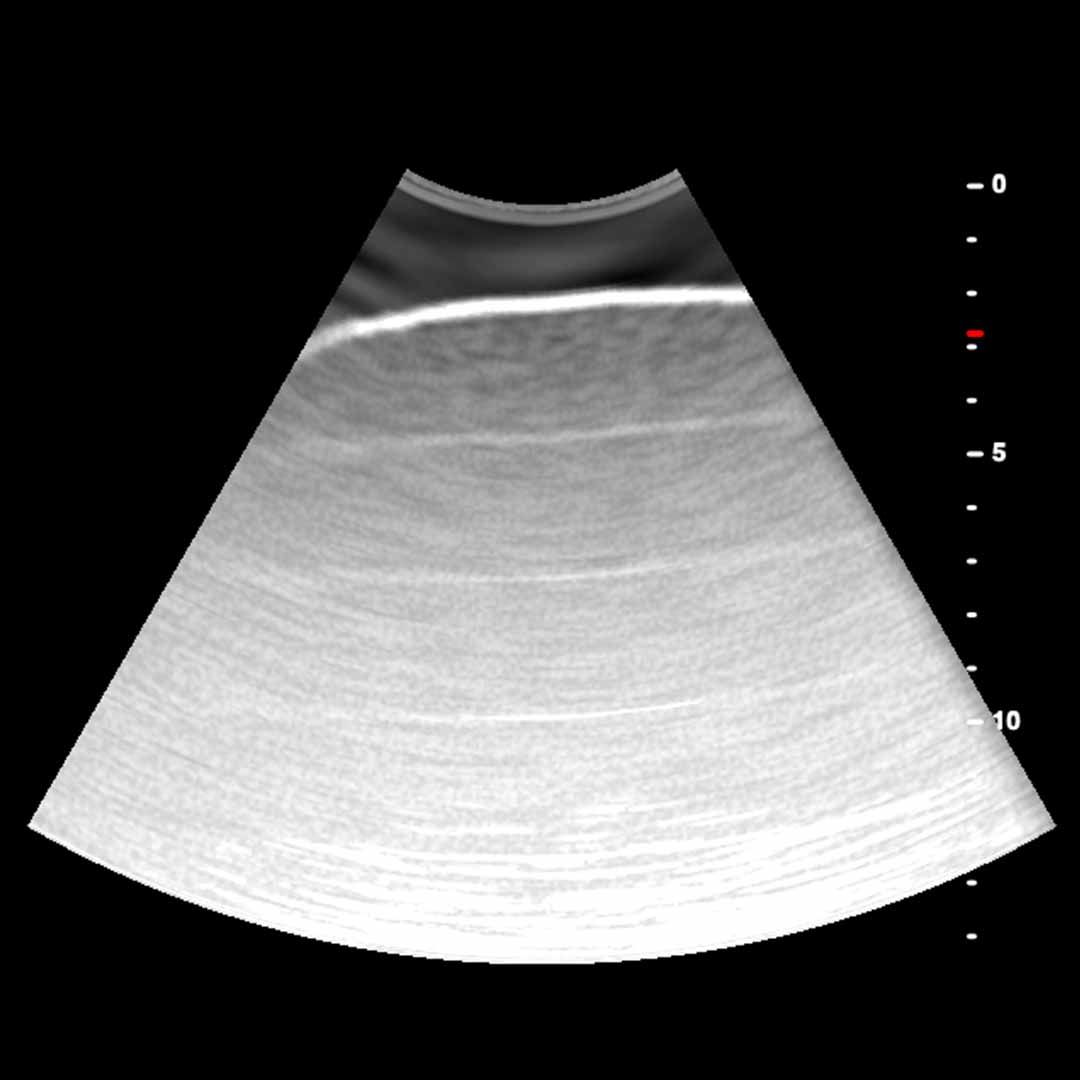 Lung ultrasound using the POCUS protocol