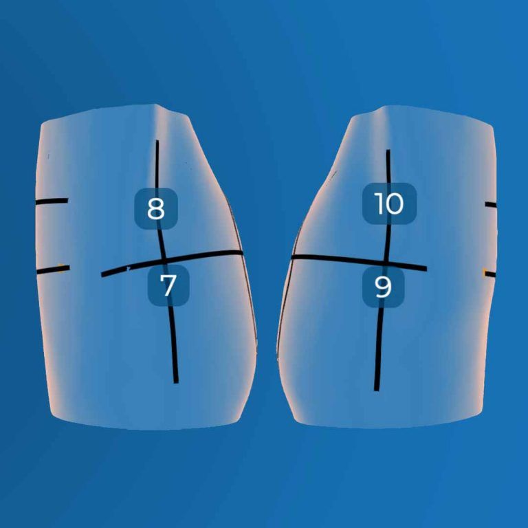 Lung ultrasound using the POCUS protocol