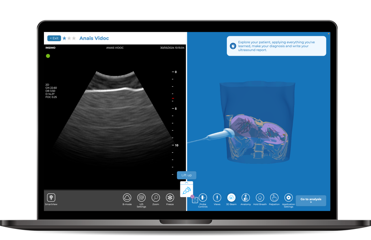POCUS Lung ultrasound