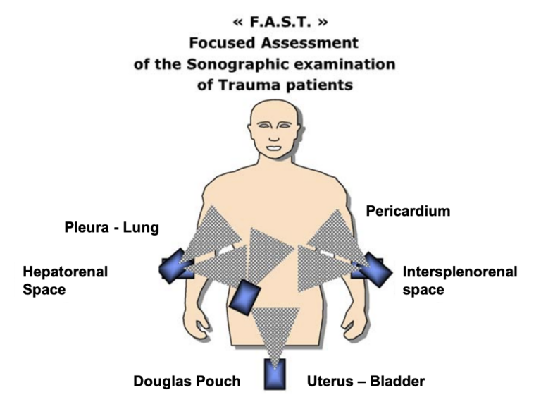 Emergency ultrasound using the FAST protocol